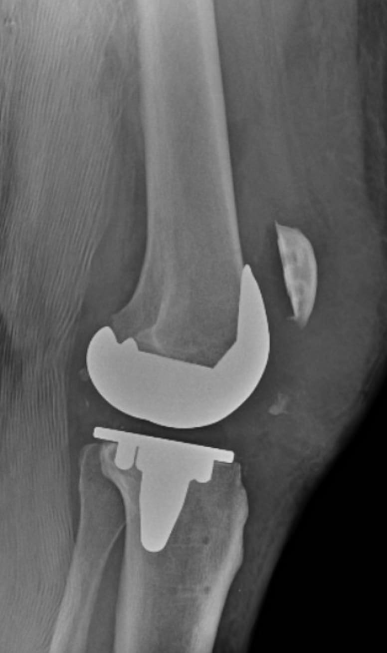 Accelerated Rehabilitation Following a Complex Patellar Tendon Rupture ...