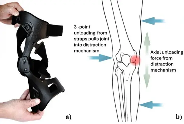 Patient Outcomes for a Novel Joint Distraction Brace